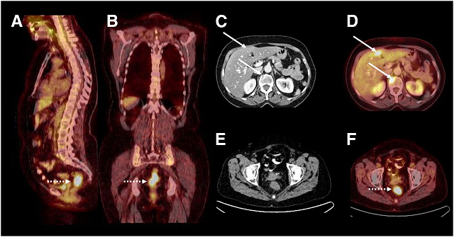 Fact Sheet: Molecular Imaging and Colorectal Cancer - SNMMI