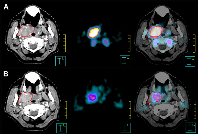 Fact Sheet: Molecular Imaging and Head and Neck Cancers - SNMMI